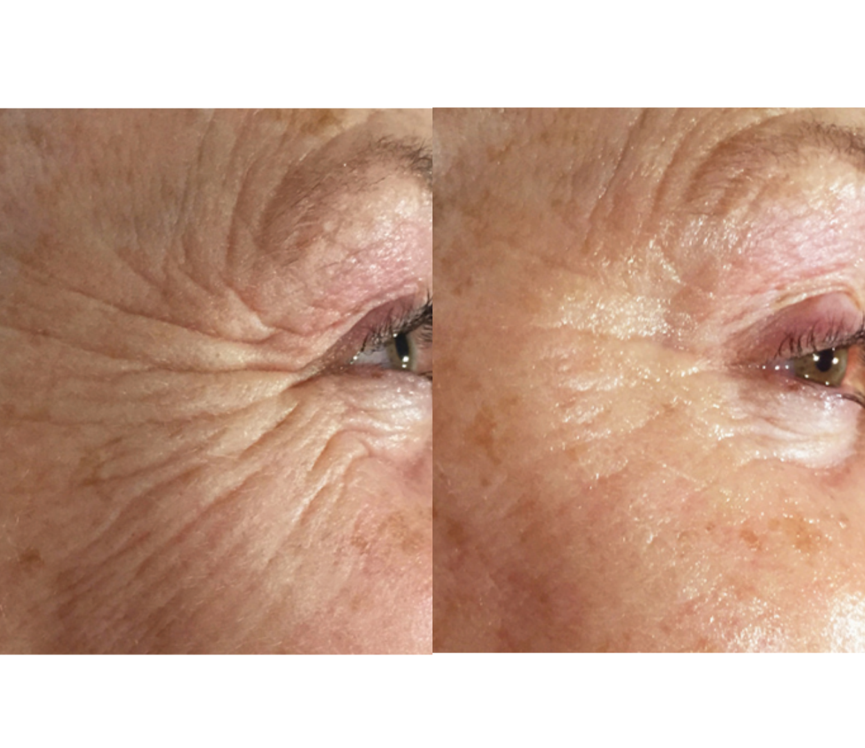 Eye Revive - Before & After | CACI Beauty