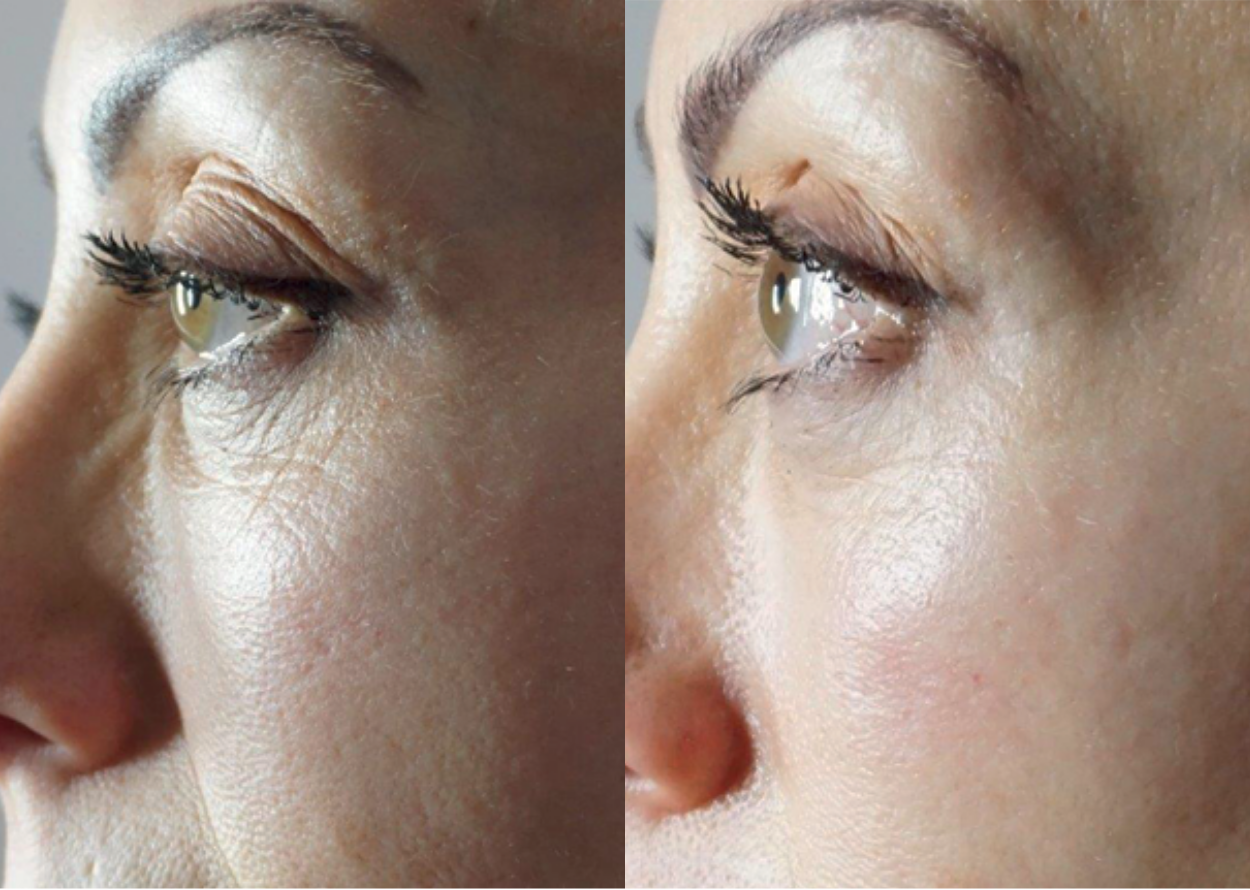 Eye Revive - Before & After - MJ's Beauty | CACI Beauty
