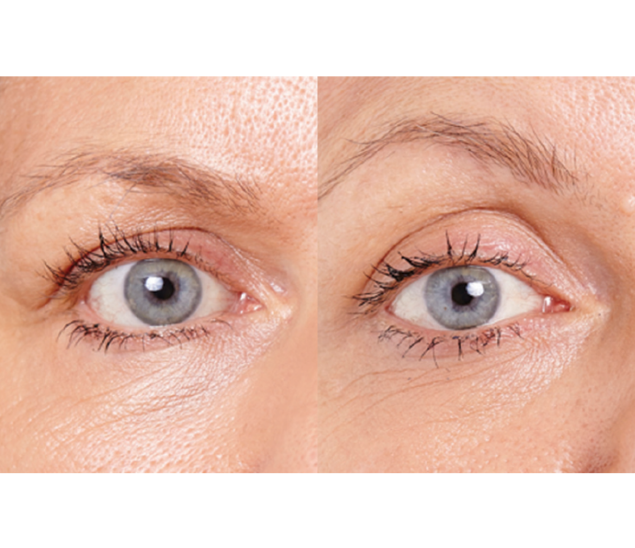 Eye Revive - Before & After | CACI Beauty