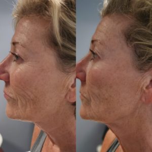 Introducing CACI’s NEW Micro-Touch Facial | CACI Beauty