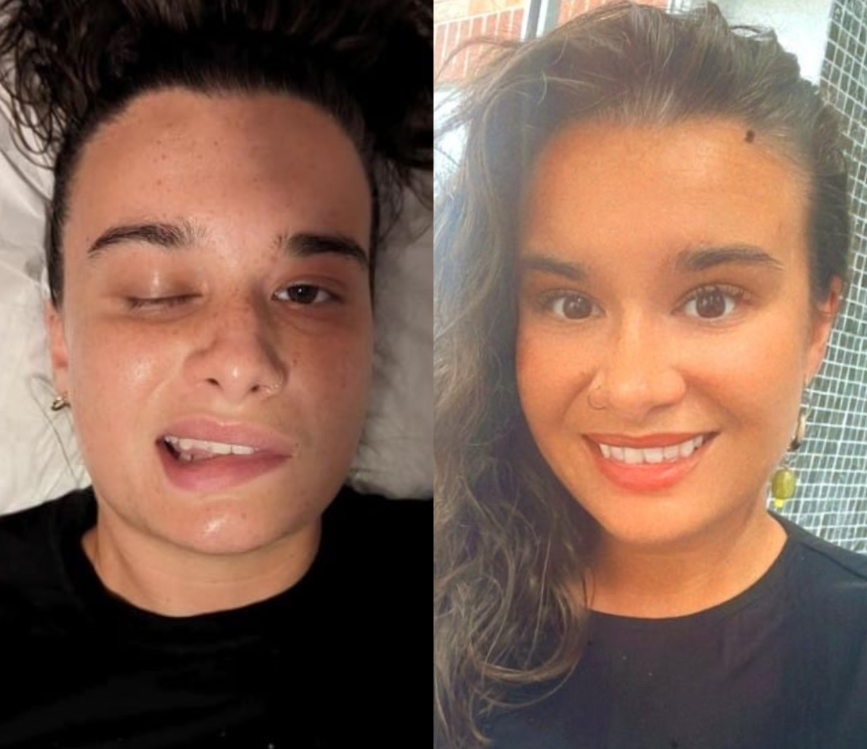 Non-Surgical Facial Toning - Before & After - The Chase CACI Clinic ...